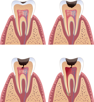 Pulpitis - Enzündung des Zahnnervs